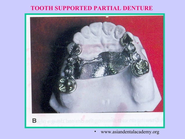 Denture base considerations in removable partial denture /RPD | PPT