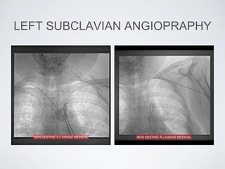 08 endovascular Bertrand aimradial20170921 Subclavian | PPT