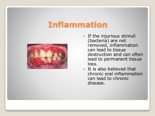 Overview of Oral Inflammation Overview of Oral Inflammation