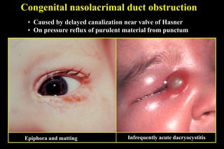 Infection Lacrimal...................ppt