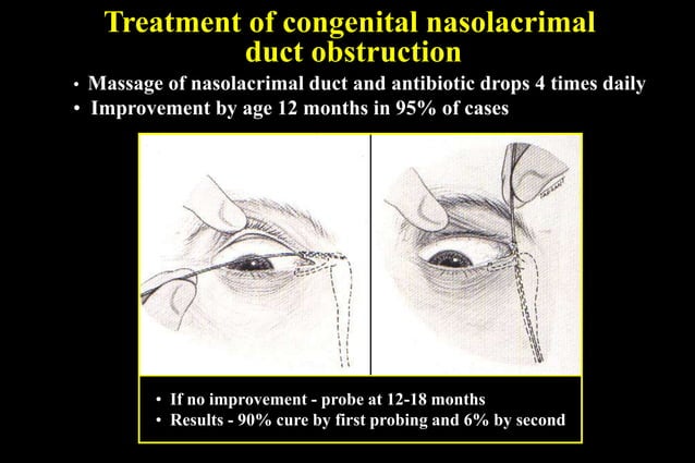 Infection Lacrimal...................ppt