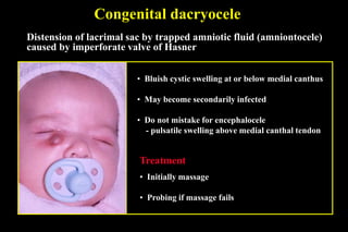 Infection Lacrimal...................ppt