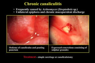 Infection Lacrimal...................ppt