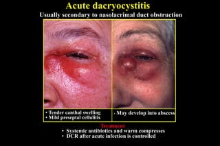 Infection Lacrimal...................ppt