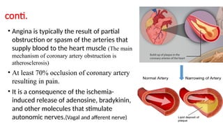 Basic ECG, Acute chest pain, angina pectoris, acute coronary syndrome ...