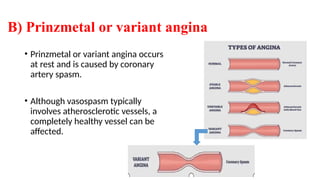 Basic ECG, Acute chest pain, angina pectoris, acute coronary syndrome ...