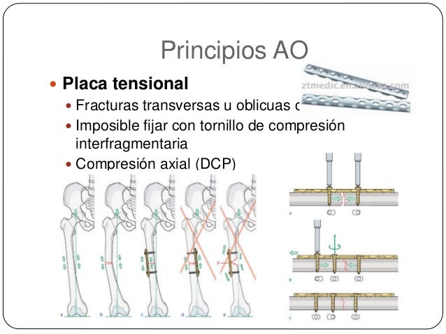 08 osteosintesis con placa