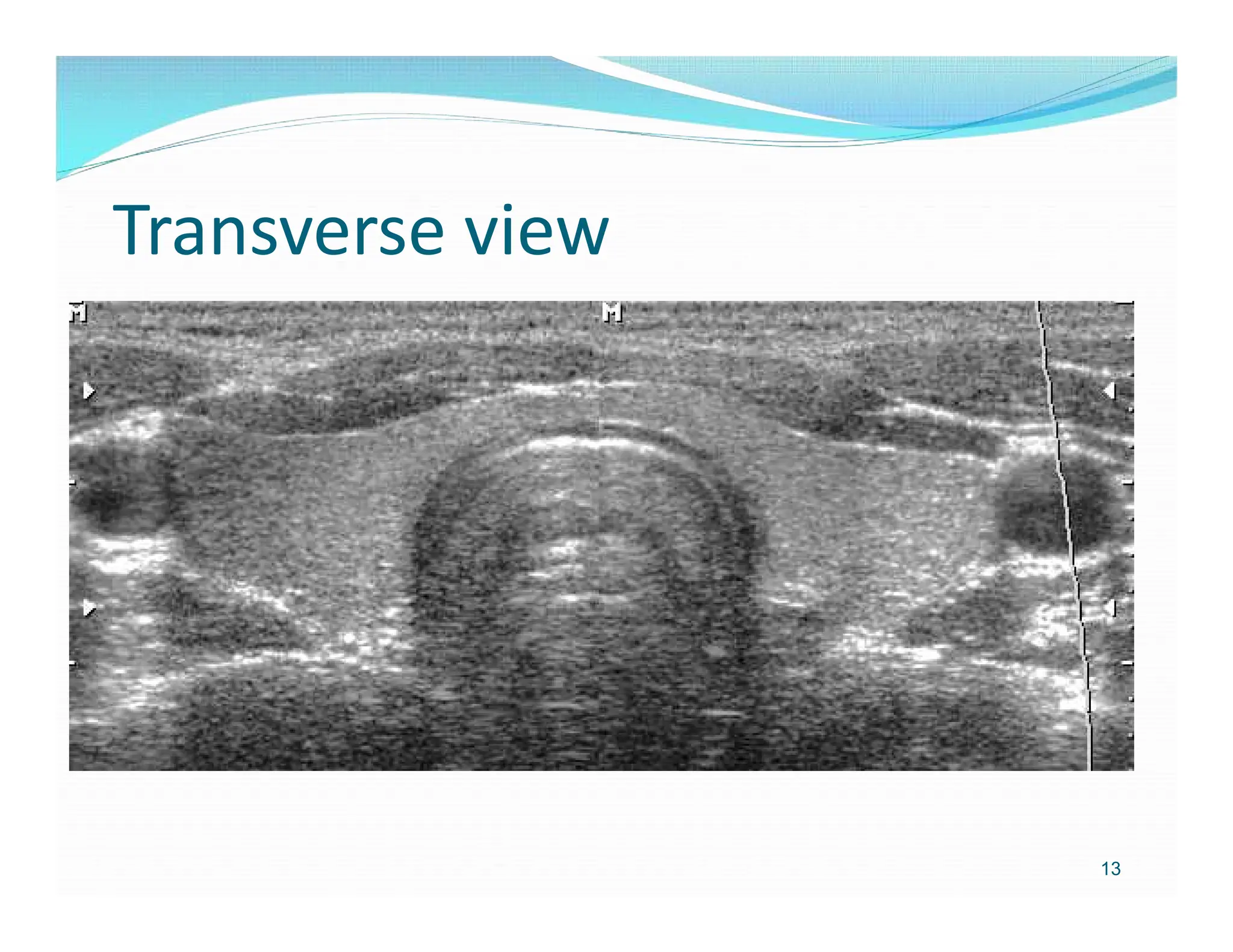 08Thyroid.pdf ultrasound of the thyroid. | PPT