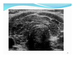 08Thyroid.pdf ultrasound of the thyroid. | PPT