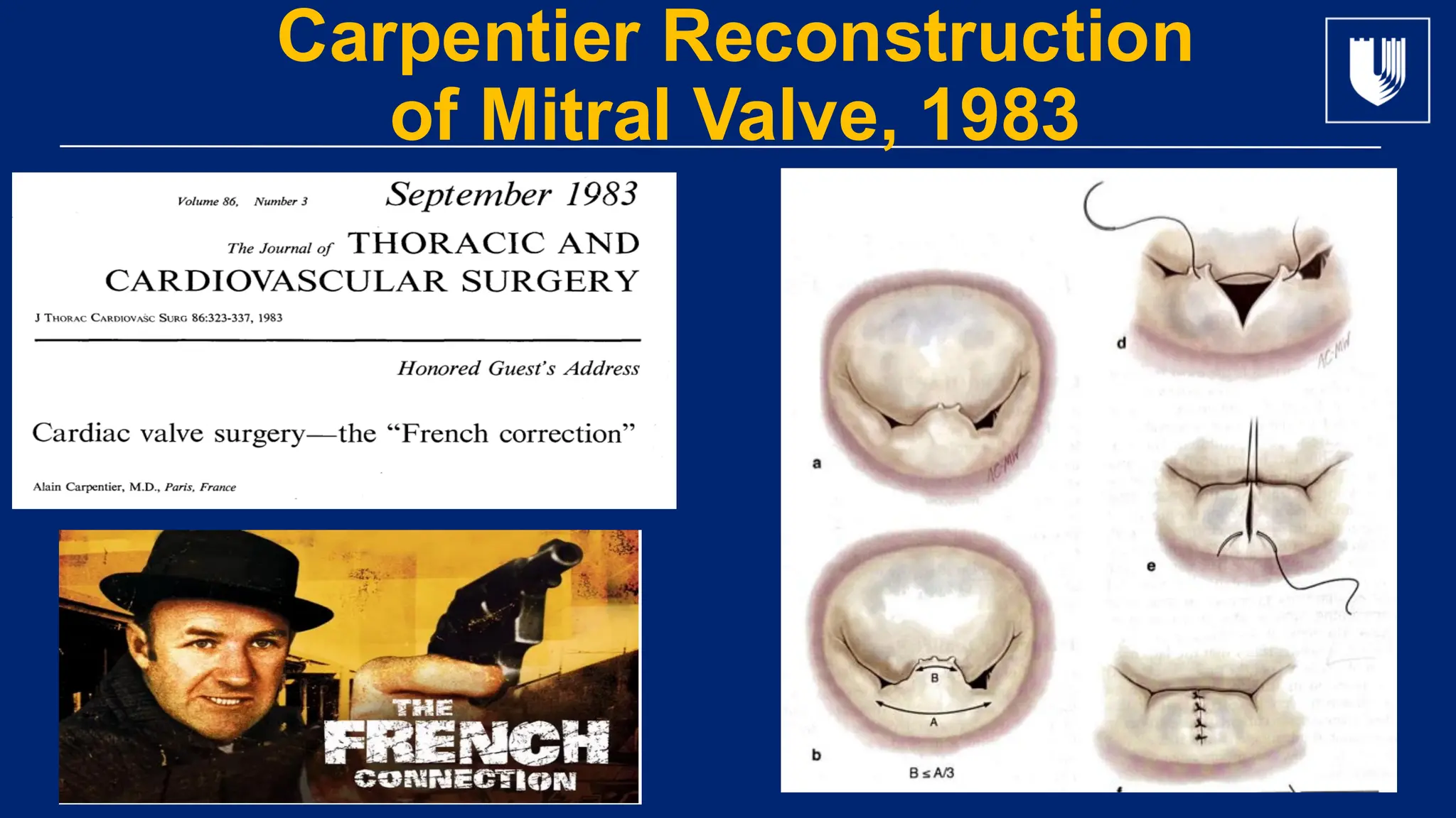 Mitral Valve Surgery for Primary MR and the Role of Robot Assistance | PDF