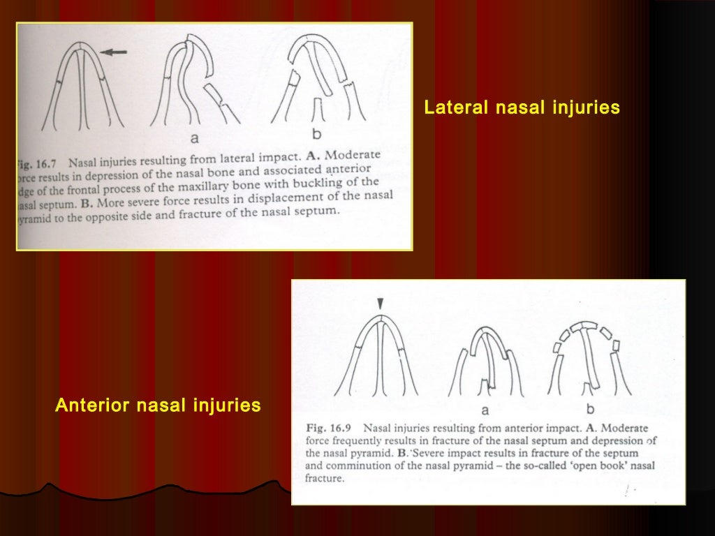 Nasal Bone Fractures