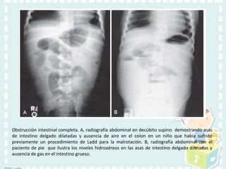 09. obstrucción intestinal por adherencias | PPT