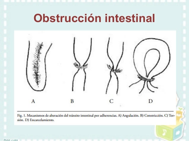 09. obstrucción intestinal por adherencias