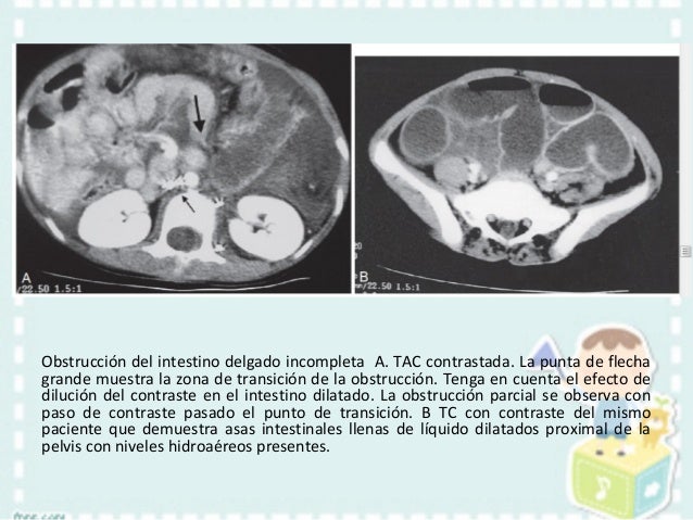 09. obstrucción intestinal por adherencias