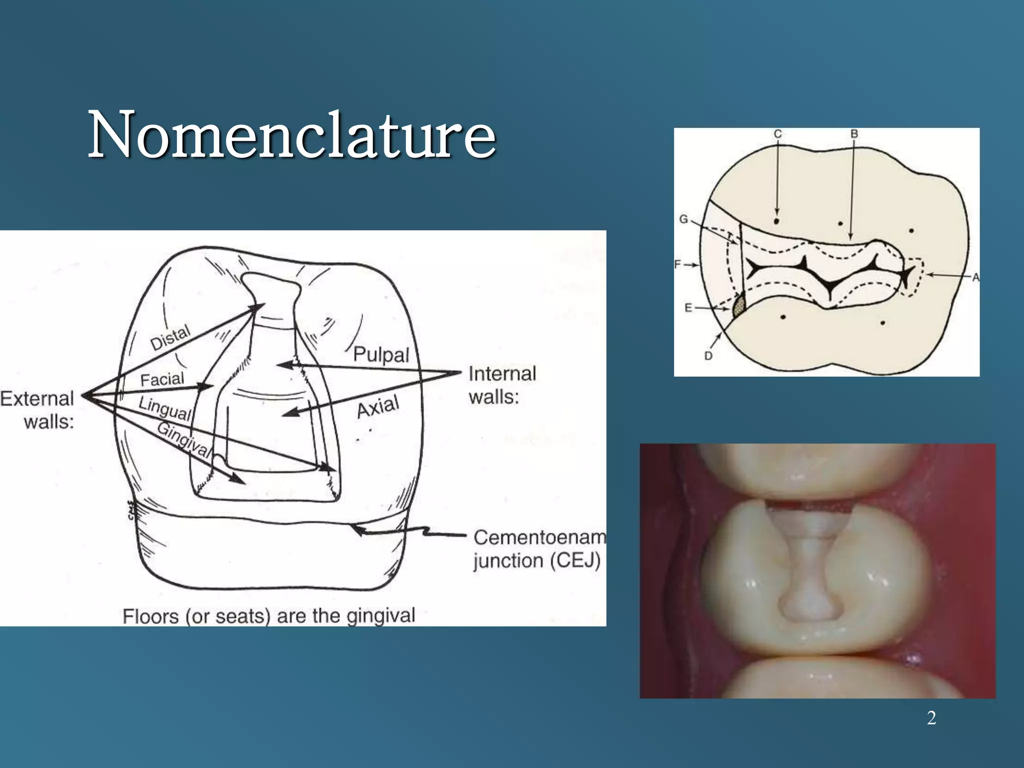 09.amalgam cavity designs | PPT