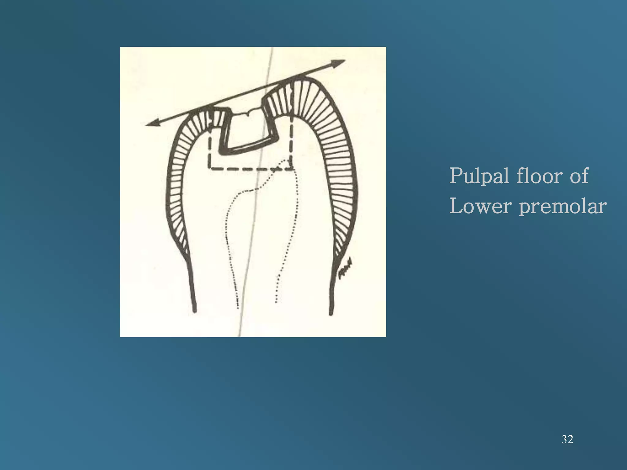 09 Amalgam Cavity Designs Pptx Dental Health Diseases And Conditions