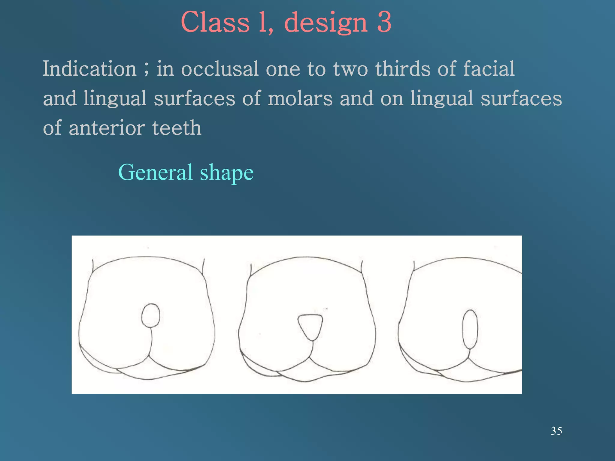 09.amalgam cavity designs | PPTX