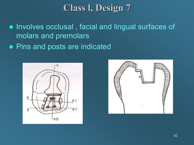 09.amalgam cavity designs | PPTX | Dental Health | Diseases and Conditions