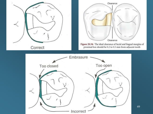 09.amalgam cavity designs | PPTX | Dental Health | Diseases and Conditions
