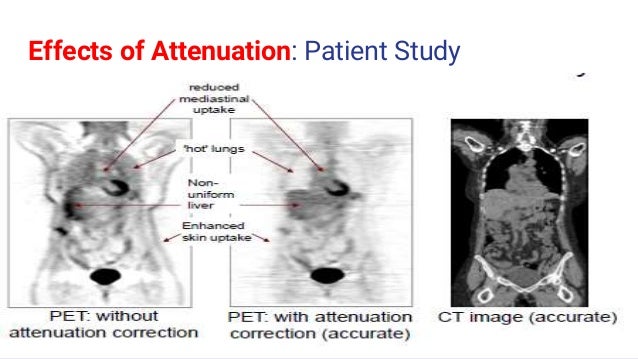 PET - Attenuation Correction (AC)