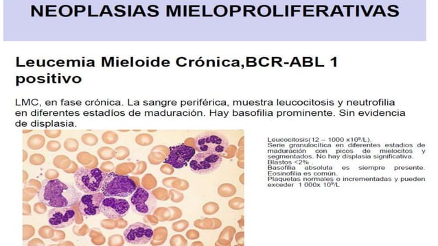 Neoplasias Mieloproliferativas Crónicas. | PPT