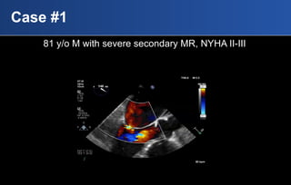 Mitral Transcatheter Edge-to-Edge Repair (T-TEER) for Secondary MR | PPTX