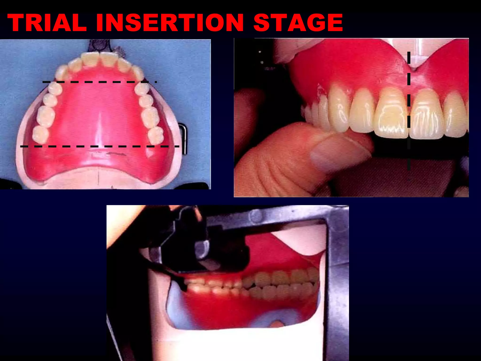 09- Occlusion in prosthodontics- occlusal correction.ppt