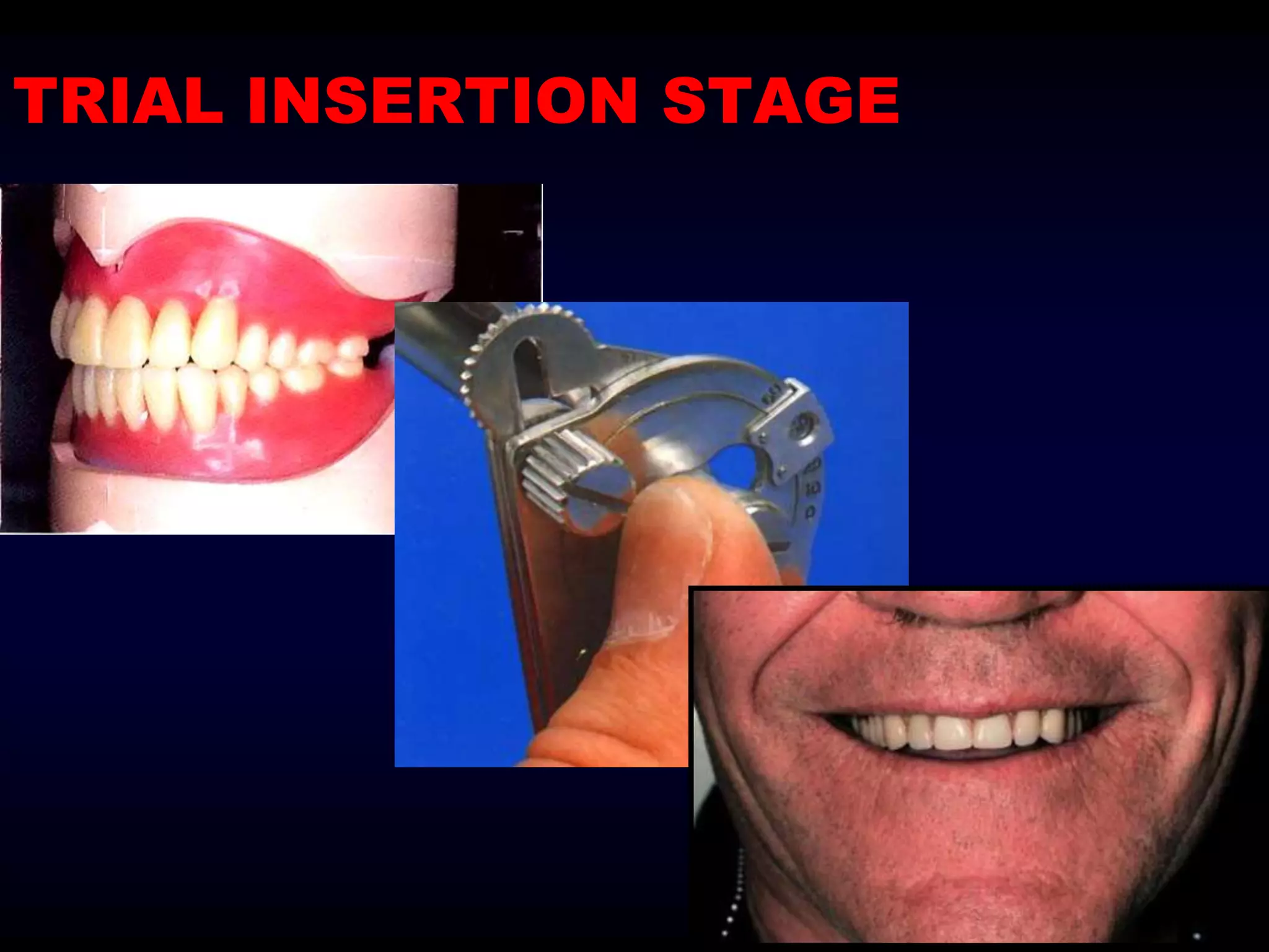 09- Occlusion in prosthodontics- occlusal correction.ppt