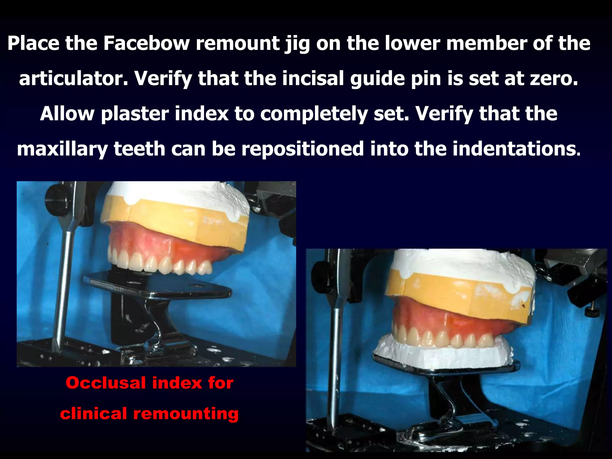 09- Occlusion in prosthodontics- occlusal correction.ppt