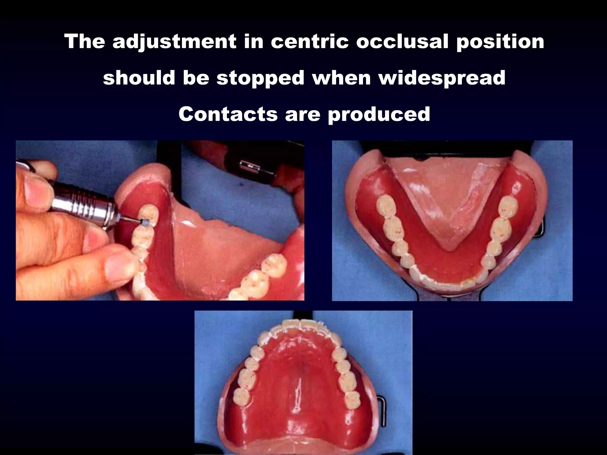 09- Occlusion in prosthodontics- occlusal correction.ppt
