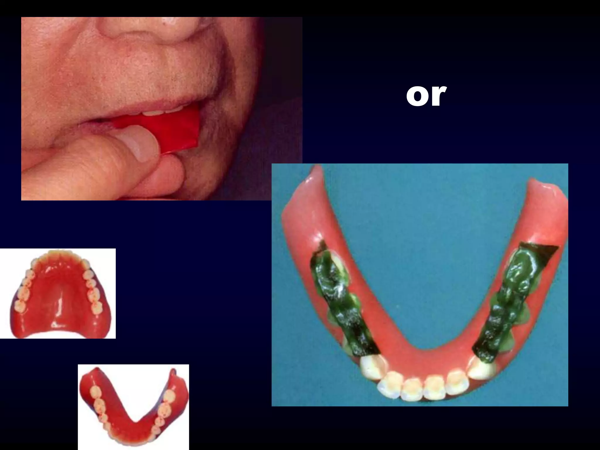 09- Occlusion in prosthodontics- occlusal correction.ppt