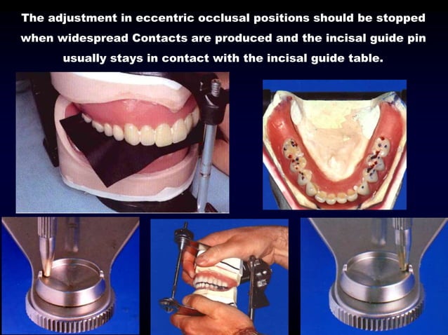 09- Occlusion in prosthodontics- occlusal correction.ppt | Dental ...