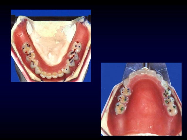 09- Occlusion in prosthodontics- occlusal correction.ppt | Dental ...