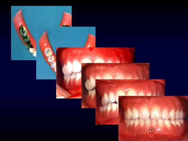 09- Occlusion in prosthodontics- occlusal correction.ppt | Dental ...