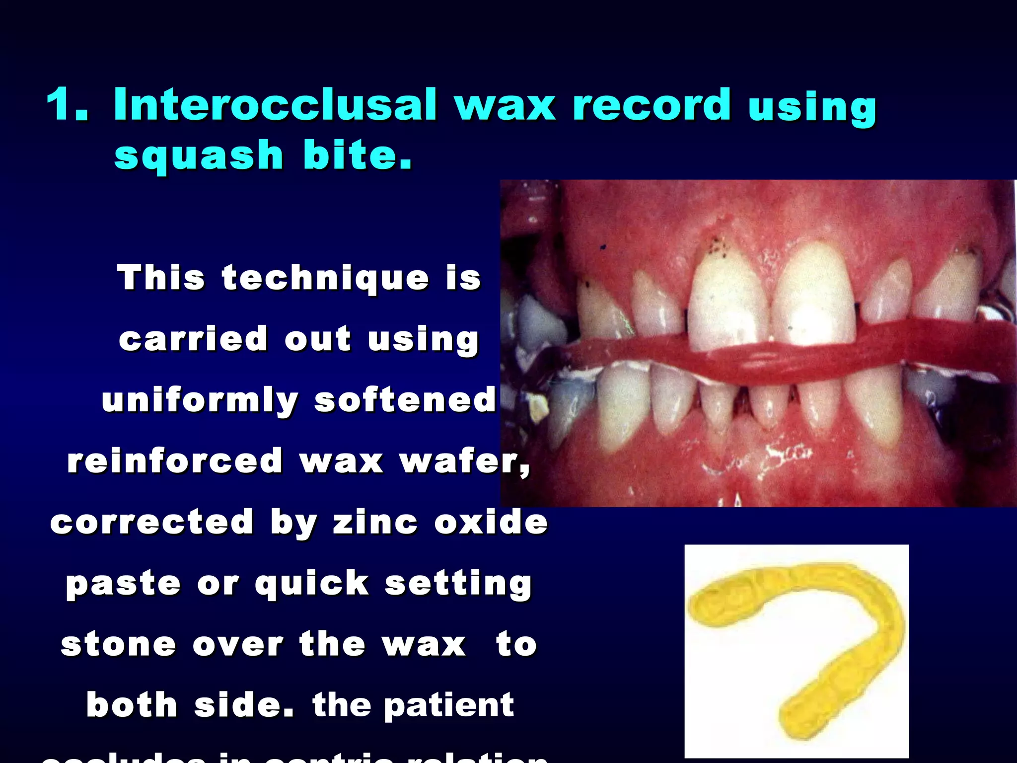 8- Occlusal Relationships for Removable Partial Dentures | PPT