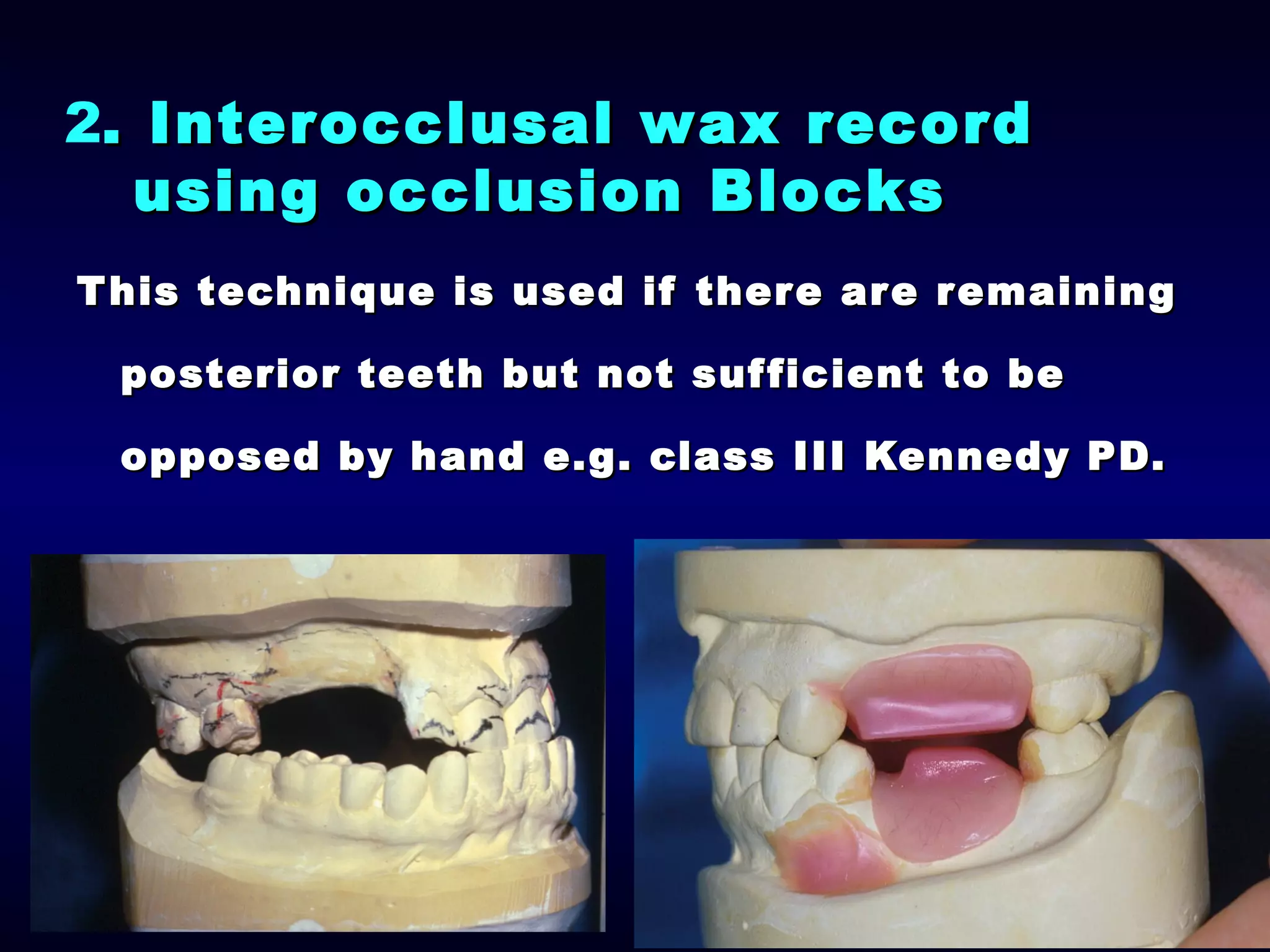 8- Occlusal Relationships for Removable Partial Dentures | PPT