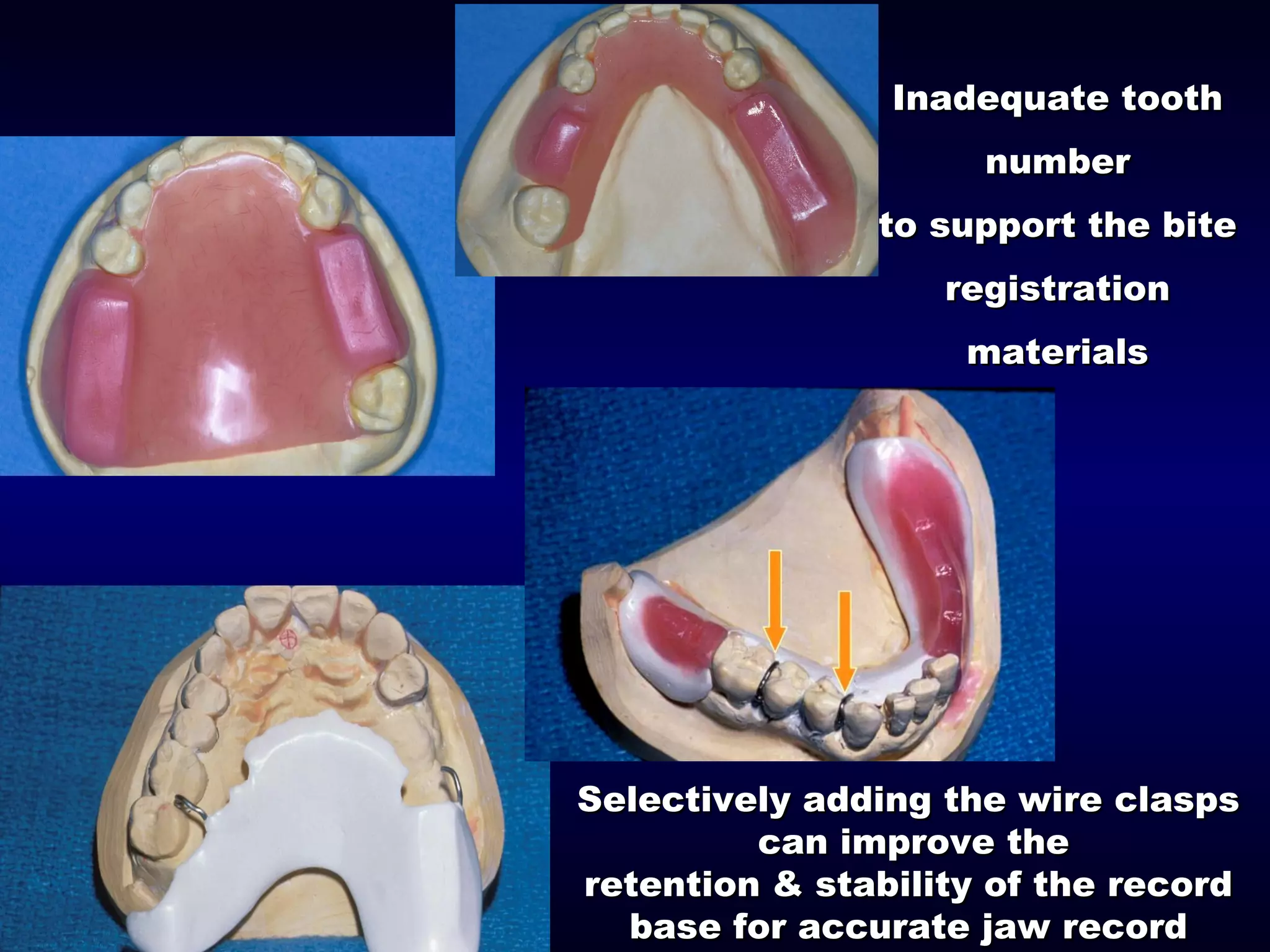 8- Occlusal Relationships for Removable Partial Dentures | PPT