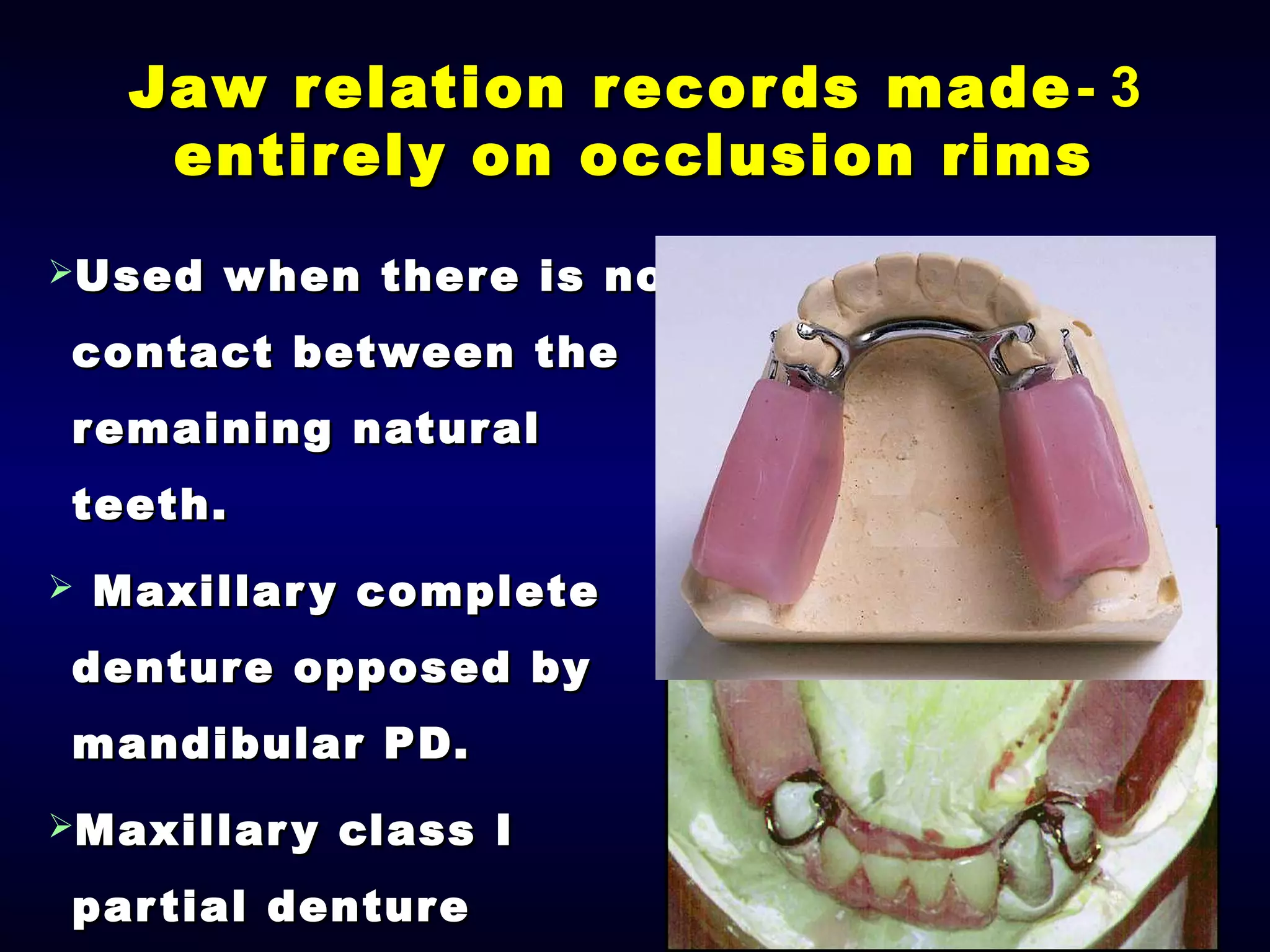 8- Occlusal Relationships for Removable Partial Dentures | PPT