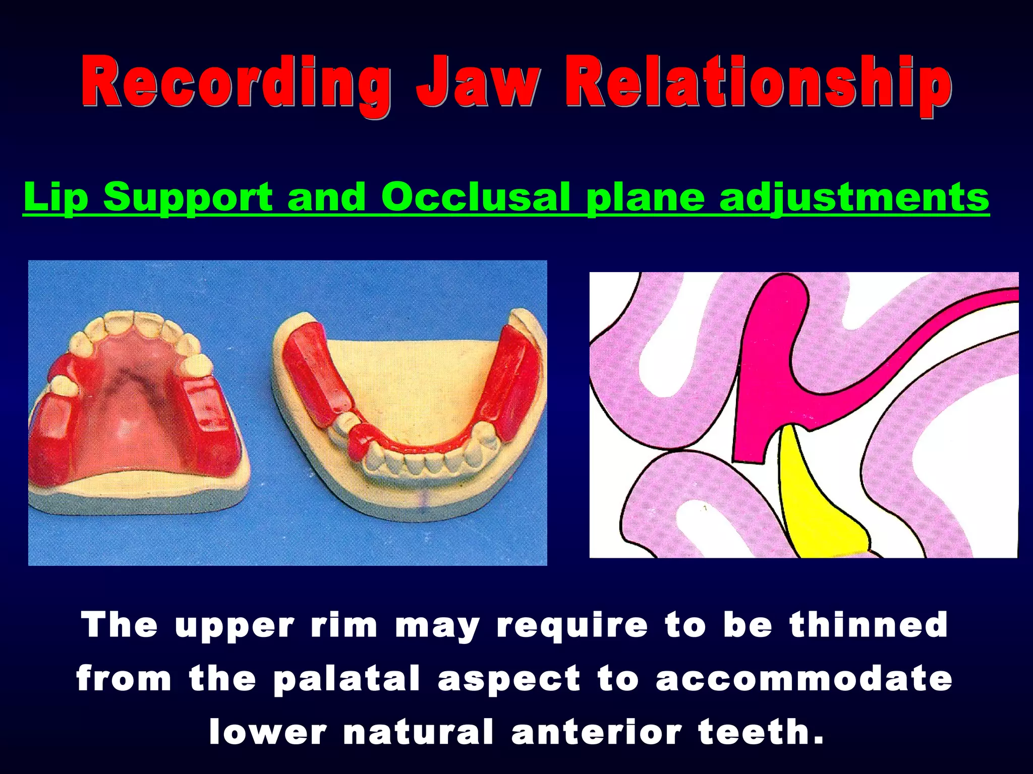 8- Occlusal Relationships for Removable Partial Dentures | PPT