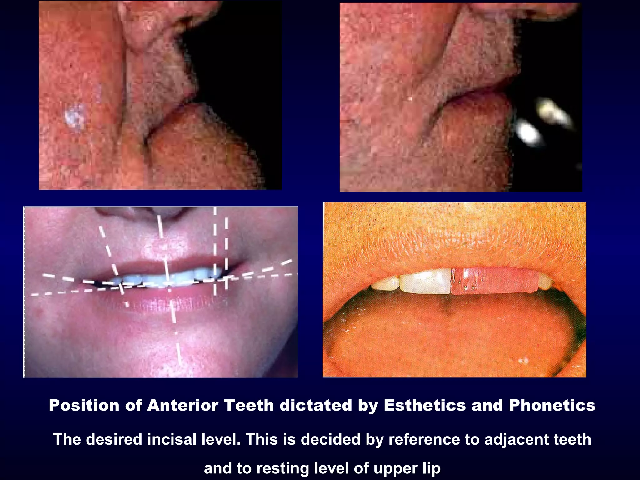 8- Occlusal Relationships for Removable Partial Dentures | PPT