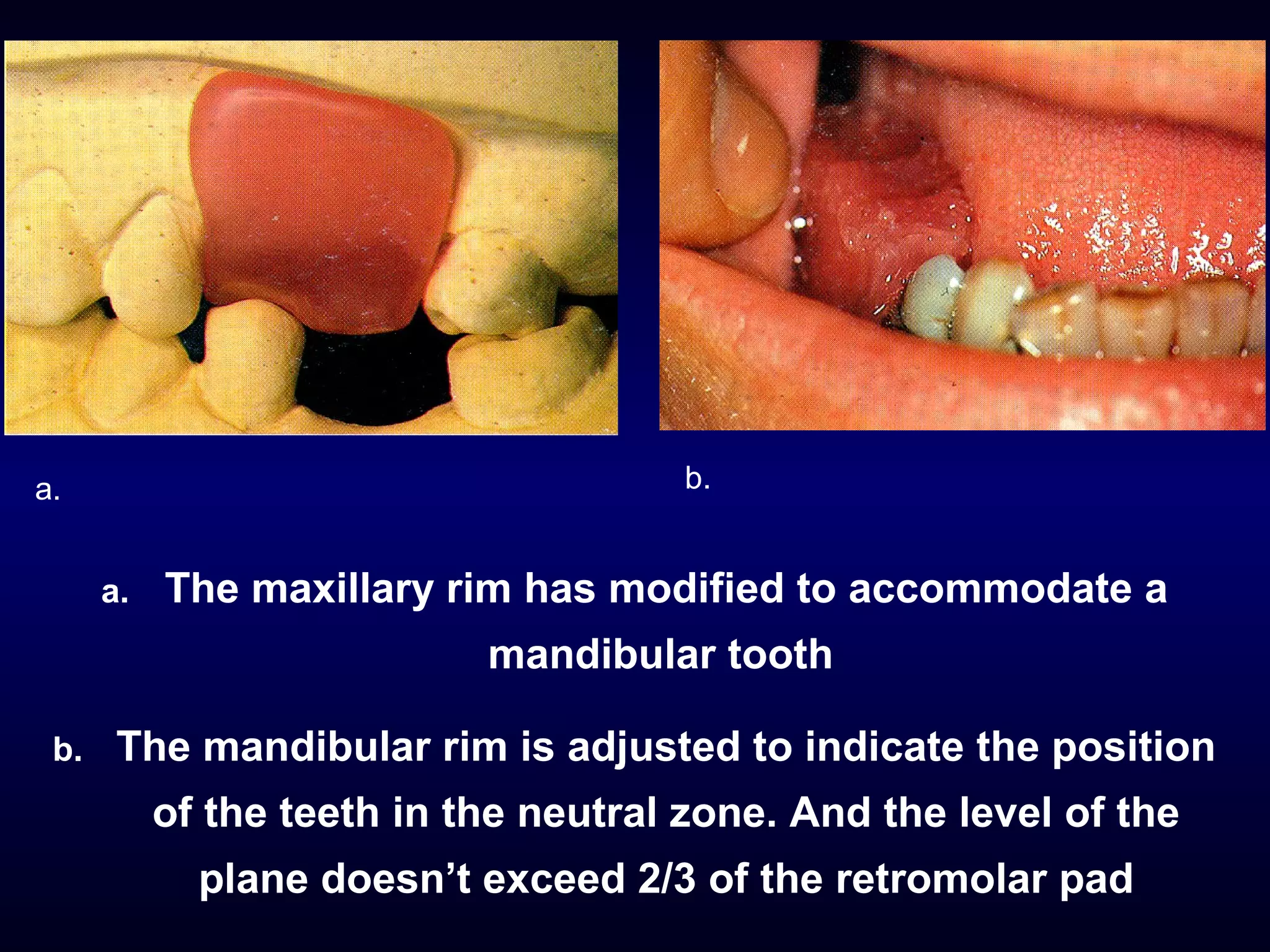 8- Occlusal Relationships for Removable Partial Dentures | PPT