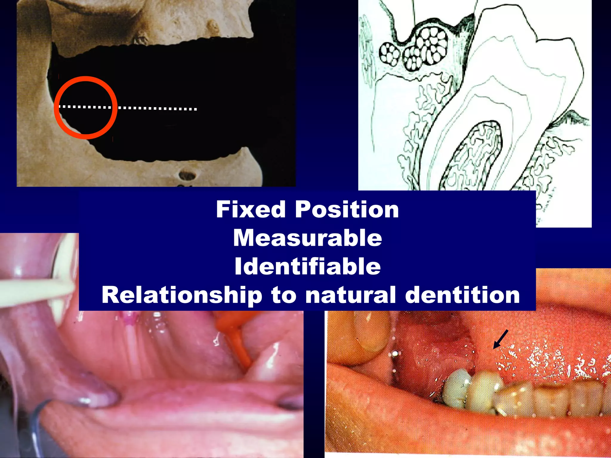 8- Occlusal Relationships for Removable Partial Dentures | PPT