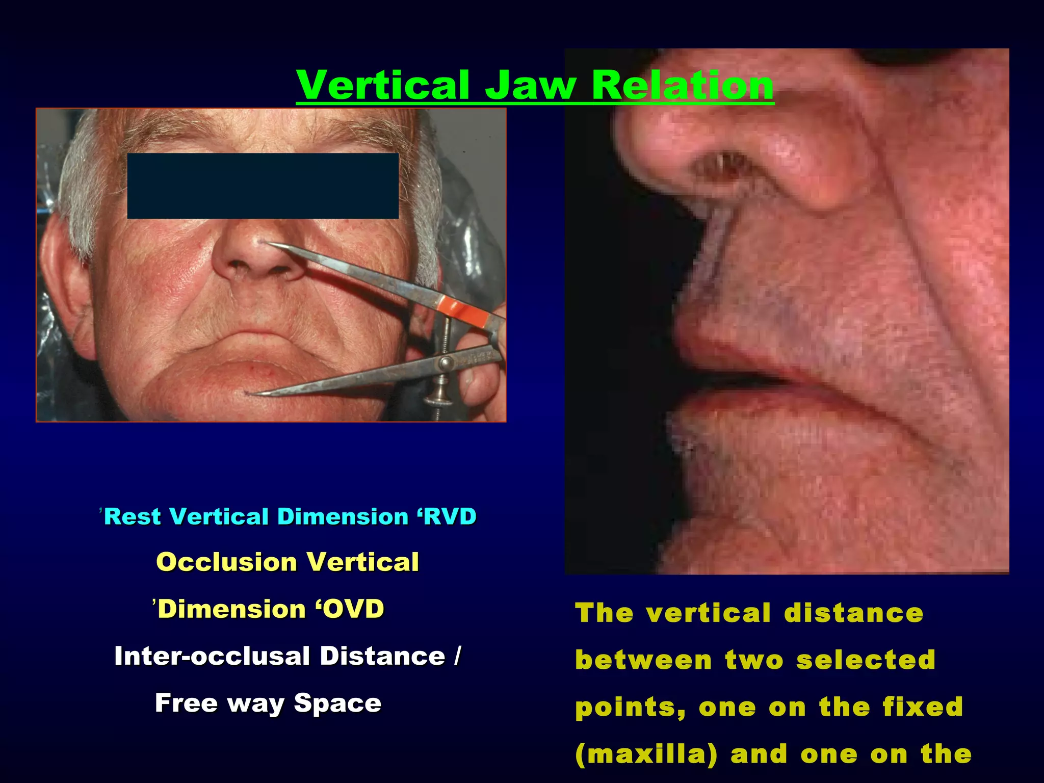 8- Occlusal Relationships for Removable Partial Dentures | PPT