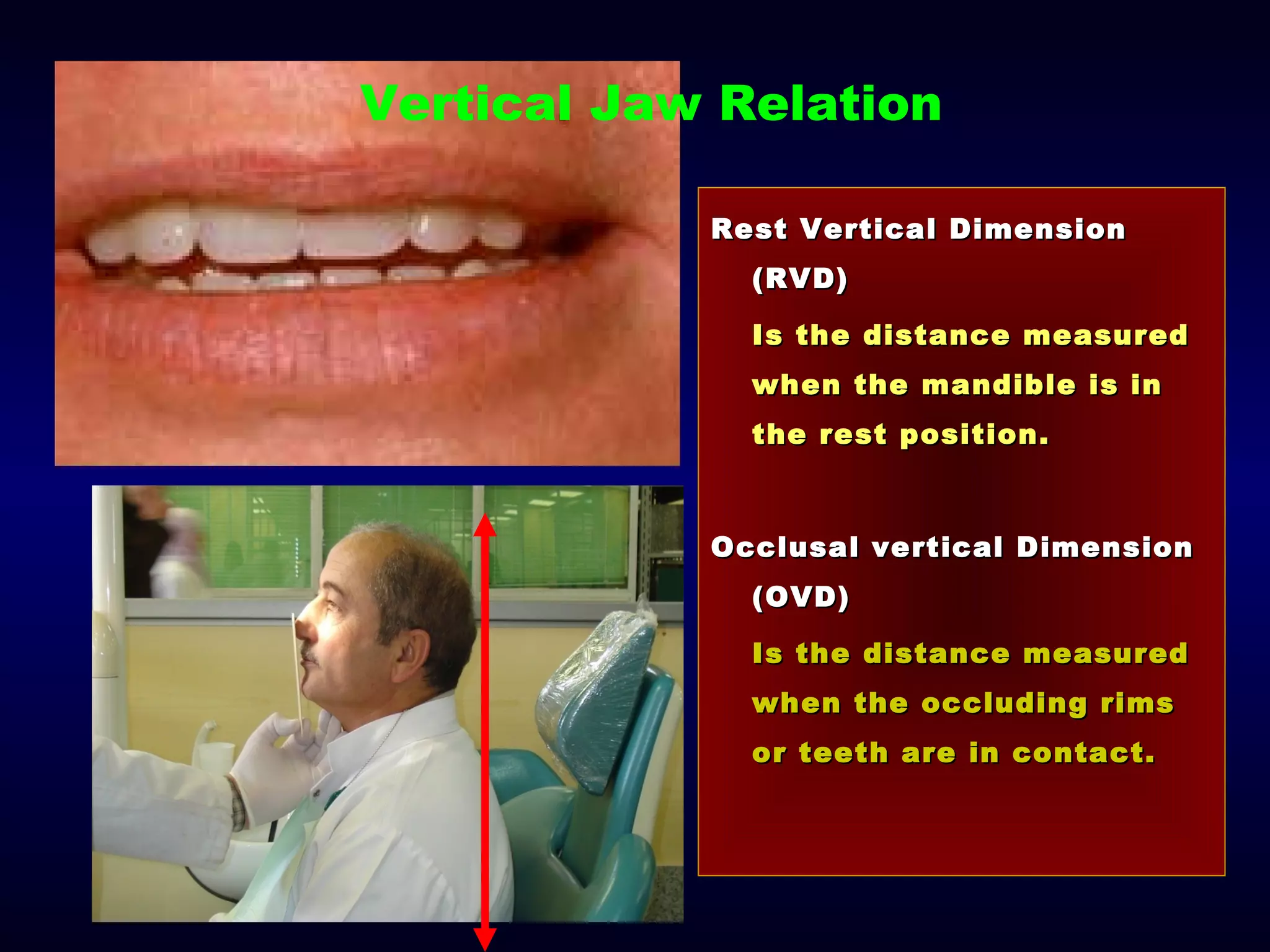 8- Occlusal Relationships for Removable Partial Dentures | PPT