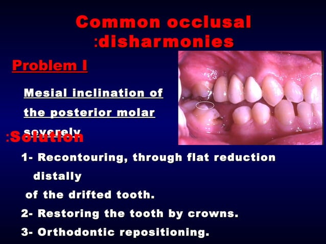 8- Occlusal Relationships for Removable Partial Dentures | PPT | Dental ...