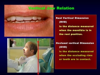 8- Occlusal Relationships for Removable Partial Dentures | PPT