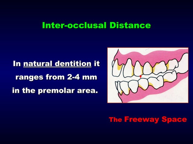 8- Occlusal Relationships for Removable Partial Dentures | PPT | Dental ...