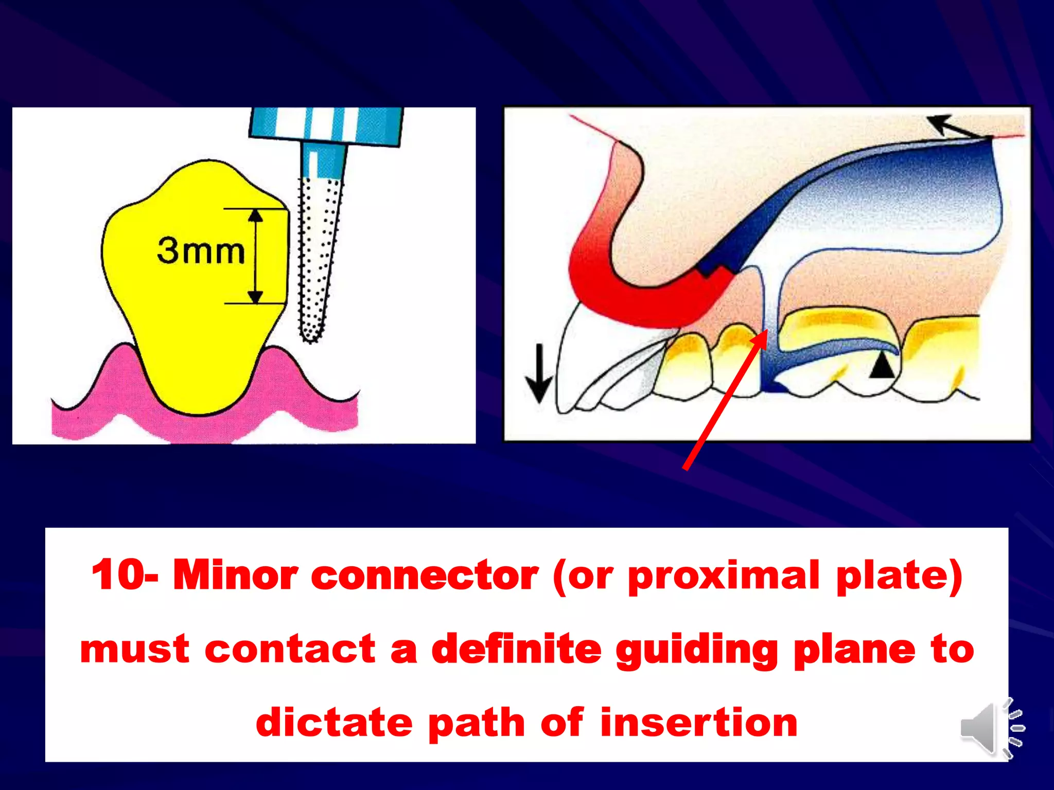 Direct Retainers of RPDs | PPT