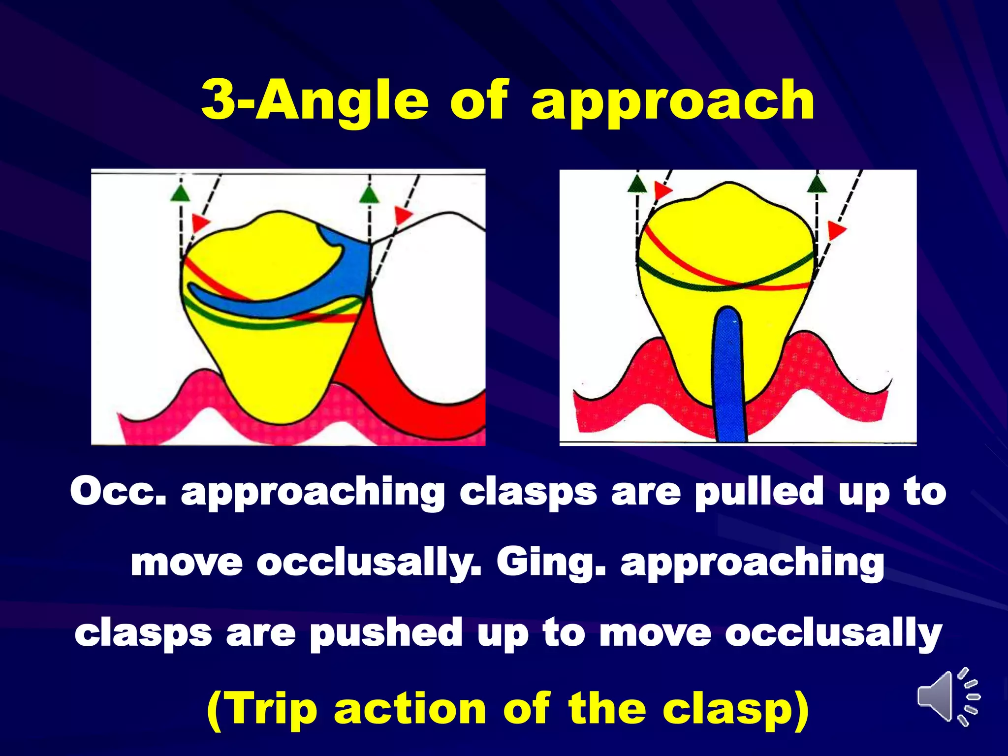 Direct Retainers of RPDs | PPT