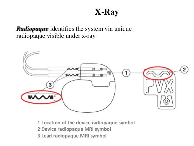 Ai Can Improve Xray Identification Of Pacemakers In